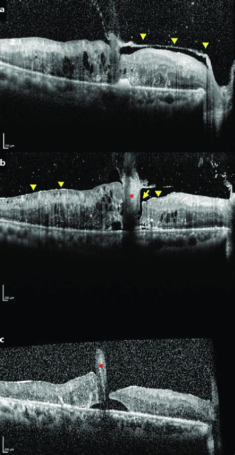 Horizontal Macular Oct Images After The Third Ivb A Four Months After
