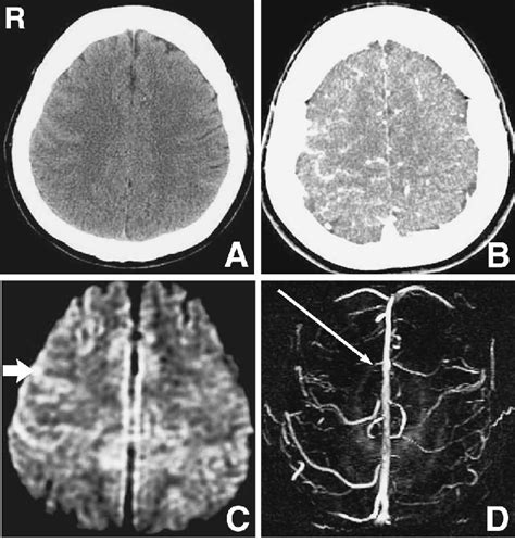 Case 4 Computed Tomography Ct Scan Without Contrast Medium A On