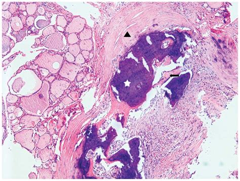 Multinodular Goiter Histology