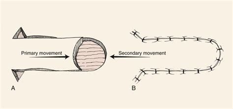 Advancement Flaps Plastic Surgery Key