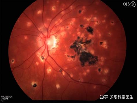 后葡萄膜炎14多灶性脉络膜炎伴全葡萄膜炎 知乎