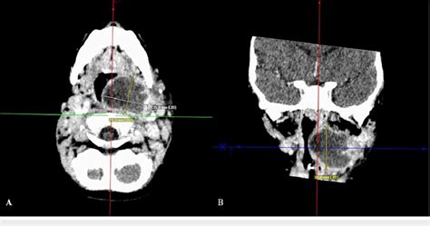 Contrasted Computed Tomography Findings A Axial View And B Coronal