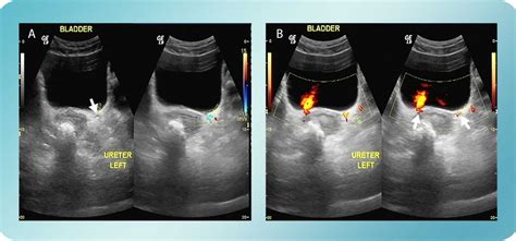Chronic Cystitis Diagnosis Georgiadis Urology
