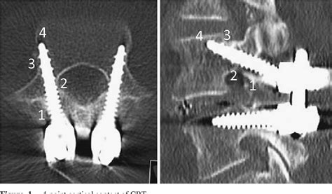Figure 1 From Lumbar Pedicle Screw Fixation With Cortical Bone Trajectory A Review From