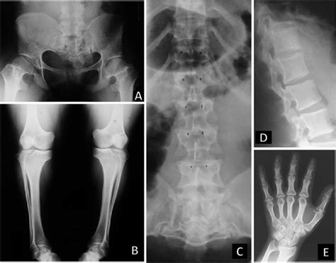 Achondroplasia Vekstdiagram
