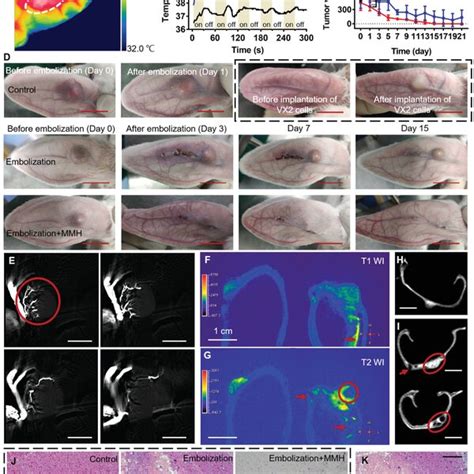 The Injectable Liquid Embolic Agent Enabled Tumor Embolization Download Scientific Diagram