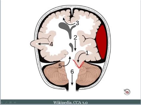 Increased Intracranial Pressure Iicp Flashcards Quizlet