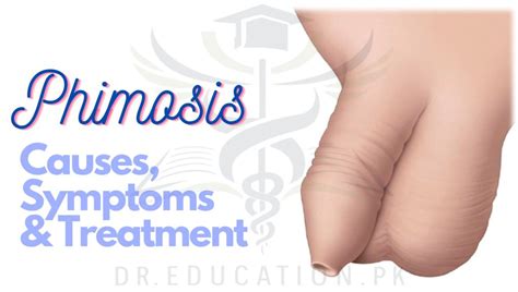 Phimosis Dr Education