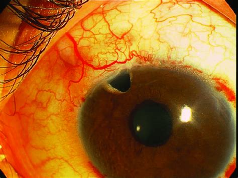 Slit Lamp Photograph One Month After Trabeculectomy The Bleb Is Download Scientific Diagram