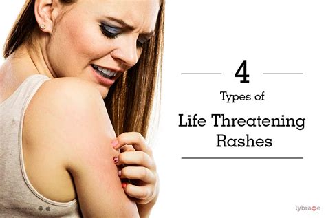 Types Of Life Threatening Rashes By Dr Nivedita Dadu Lybrate