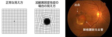 抗vegf抗体療法 新宿駅東口徒歩1分の眼科｜新宿東口眼科医院
