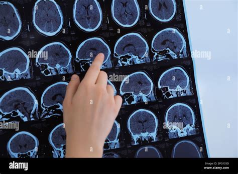 Doctor Examining MRI Images Of Patient With Multiple Sclerosis In