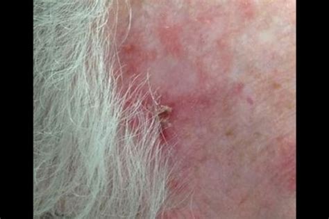 Clinical Challenge Lesion On The Temple Mpr