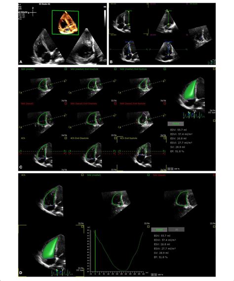 The Process Of Fully Automated Right Ventricular Rv Analysis After Download Scientific