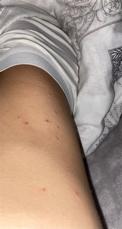 Does Anybody Know What This Is Some Weird Pimple Look Alike On My
