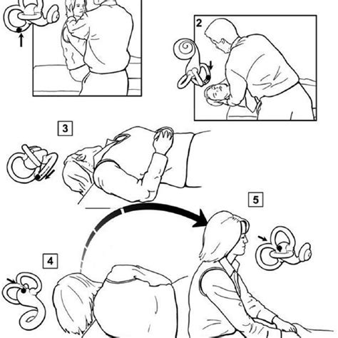Gufoni Maneuver For Treatment Of Right Sided Lateral Semicircular Canal