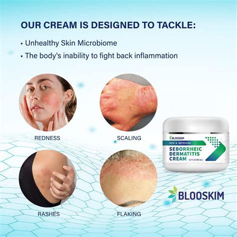 Seborrheic Dermatitis Face Cream