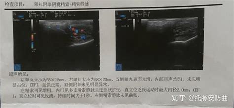 检查出精索静脉曲张，医生没有开药让我回去保守治疗 知乎
