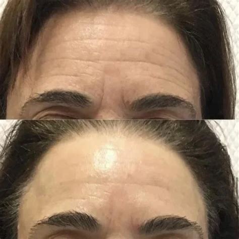 Microcurrent At Home Before And After At Gene Courtney Blog