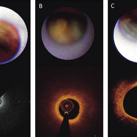 Yellow Neointima By Angioscopy And Corresponding Oct Images A A
