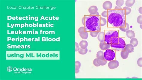 Acute Lymphoblastic Leukemia All Detection Using Deep Learning Models