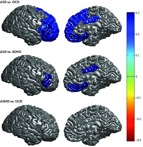 The Best Adhd Brain Vs Normal Brain Bimcomwasuty