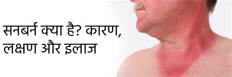 सनबर्न क्या है कारण लक्षण और इलाज Sunburn In Hindi