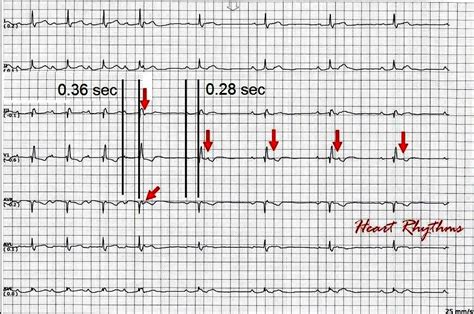 ECG Rhythms Second Degree AV Block Type I Interrupted By Nonconducted PAC S In Bigeminy