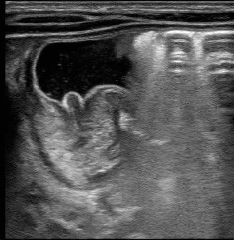 Pyloric Stenosis Emory School Of Medicine