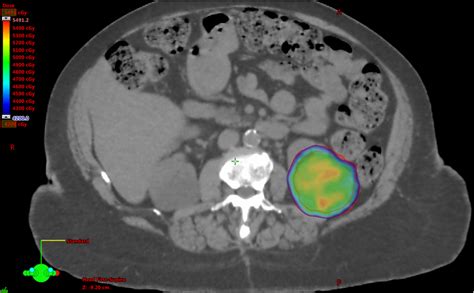 legend axial view of dosimetry as seen on planning ct demonstrates