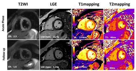 Multiparametric Cardiac Mr Can Accuratelydetect And Monitor Inflammatory Myocardial Injuries In