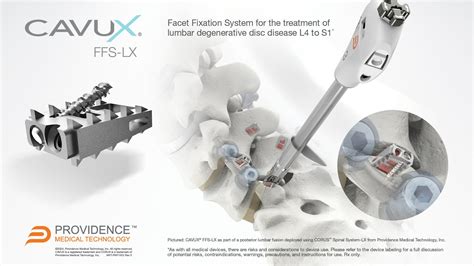 Pmt Secures Fda Approval For Cavux Lumbar Facet Fixation System
