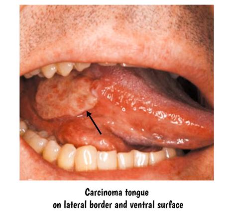 Carcinoma Oral Cavity Causes Symptoms And Treatment Options