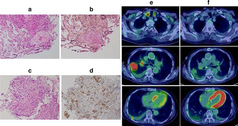 Pathology And Positron Emission Tomography‐computed Tomography Pet‐ct