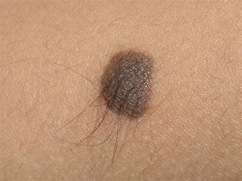 Examples Of Moles And Freckles Royal Park Medical