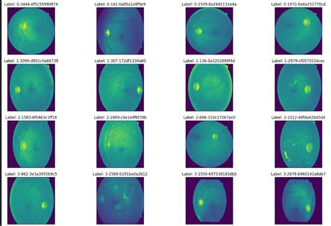 Eyesnap Diabetic Retinopathy Detection With Diascan Devpost