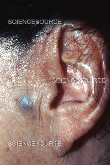 Blue Nevus