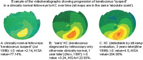 Genetics Of Keratoconus Ento Key