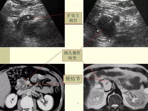 胰腺导管内乳头状黏液瘤 胶南市