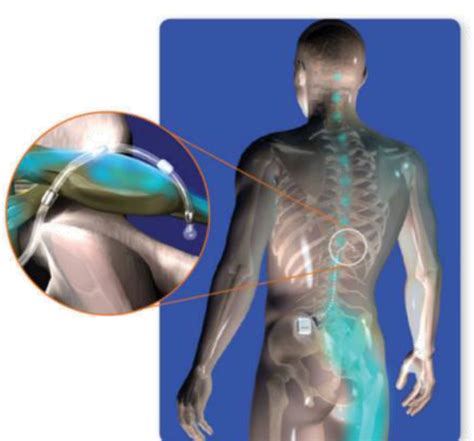 Dorsal Root Ganglion Stimulation Drg