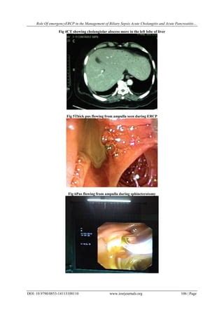 Role Of Emergency ERCP In The Management Of Biliary Sepsis Acute Cholangitis And Acute