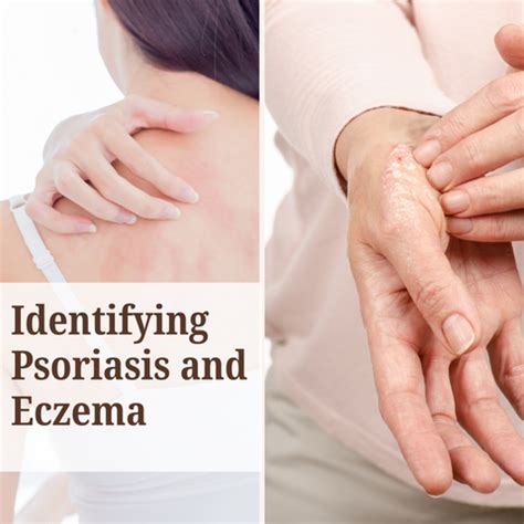 Understanding the Differences Between Psoriasis and Eczema | Clinikally