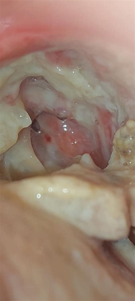 Exposed Blood Vessel After Tonsillectomy Scab Came Off And Several