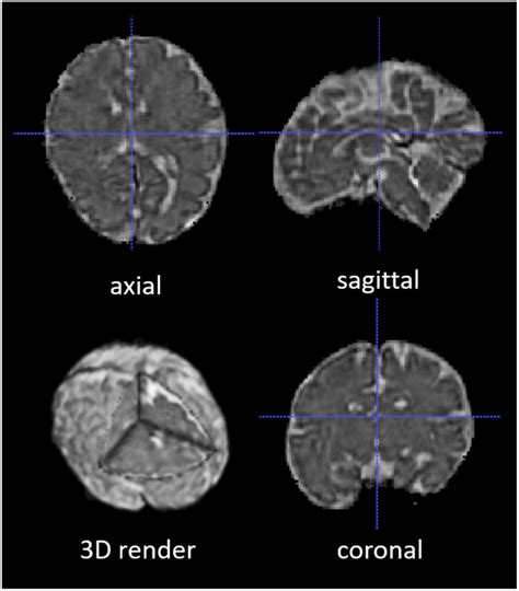 Frontiers Semi Automatic Segmentation Of The Fetal Brain From Magnetic Resonance Imaging