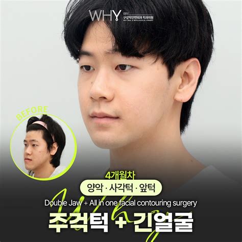 와이구강악안면외과 💜why Beforeandafter💜 ⠀ 양악 사각턱 앞턱 수술 After Facebook