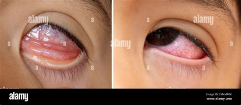 Macro Of A Very Red Eye With Oriental Features Due To Conjunctivitis Dryness And Redness Of The