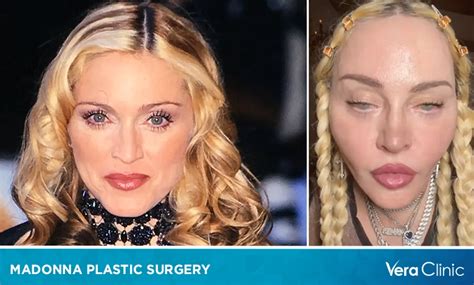 Madonna Plastic Surgery Before And After Through The Years