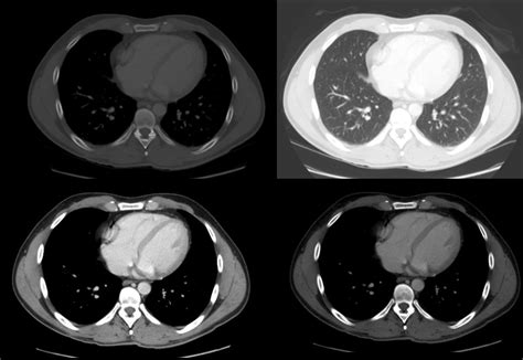 ct windowing