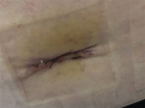 20 Year Old Cyst On Hip And Healing Process R Popping