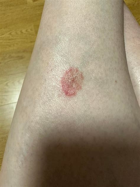 진드기 물린 자국 뭘까요 ㅜㅜ 지식in